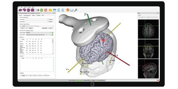 Added value of MRI-guided neuronavigation