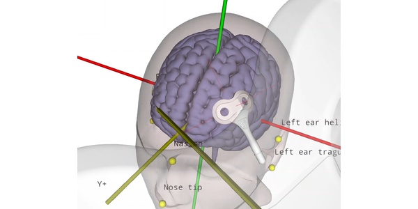 Reproducible coil placement using MNI