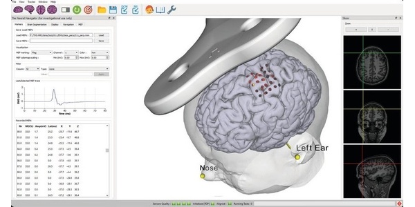 The principles and application of MRI-Guided Neuronavigation